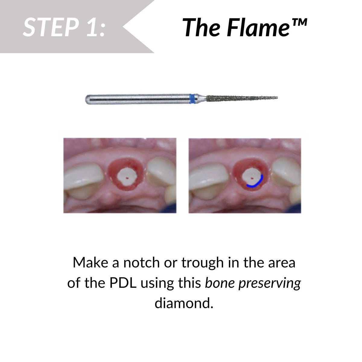 The Flame™ | Bone Preserving Diamond for extractions