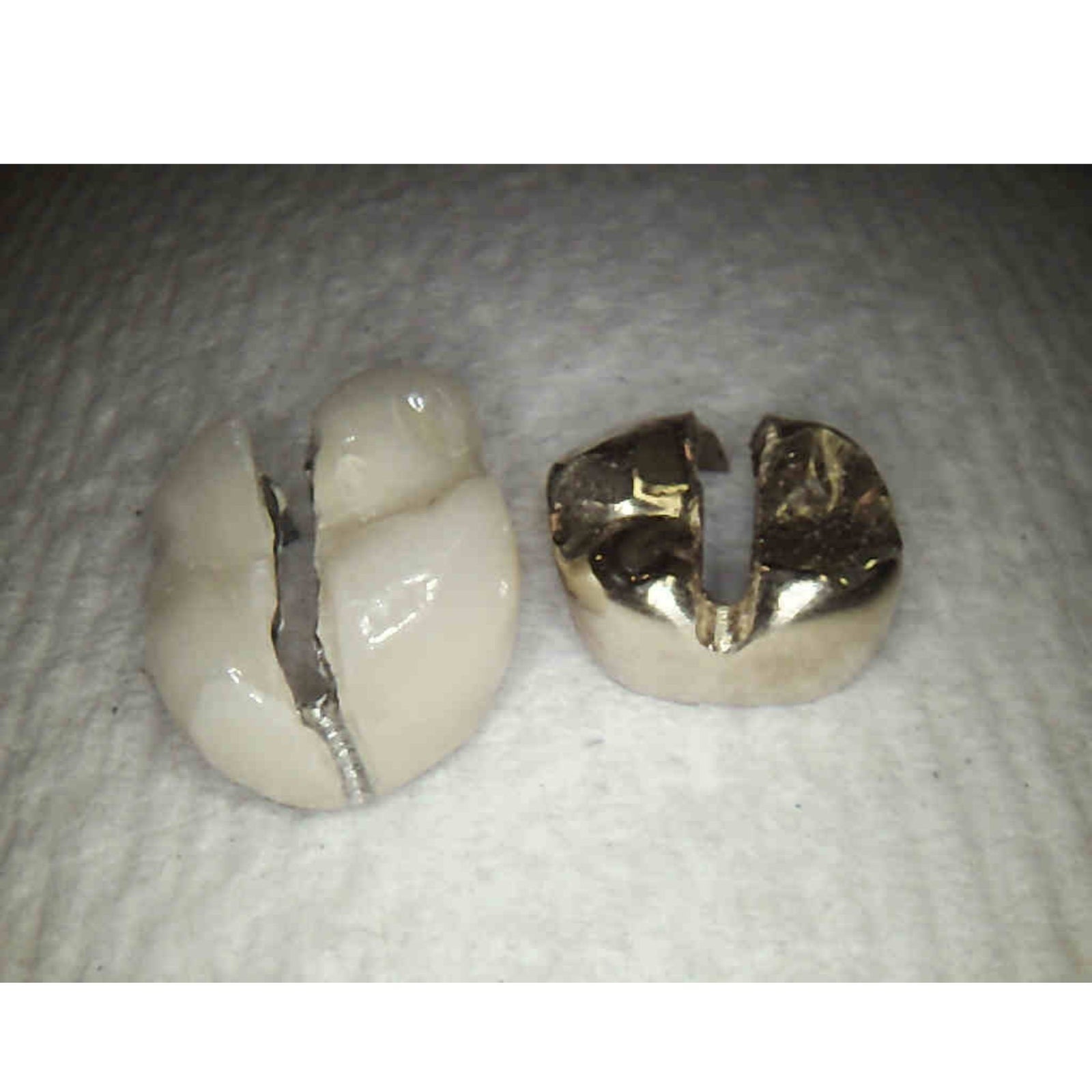 Best Dental Crown Remover: How to Remove a Dental Crown in Under a Min