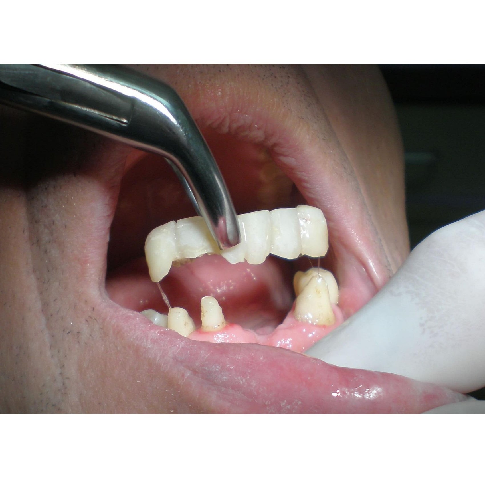 TempOff® | Temporary Crown Remover | Temporary Crown Removal Tool