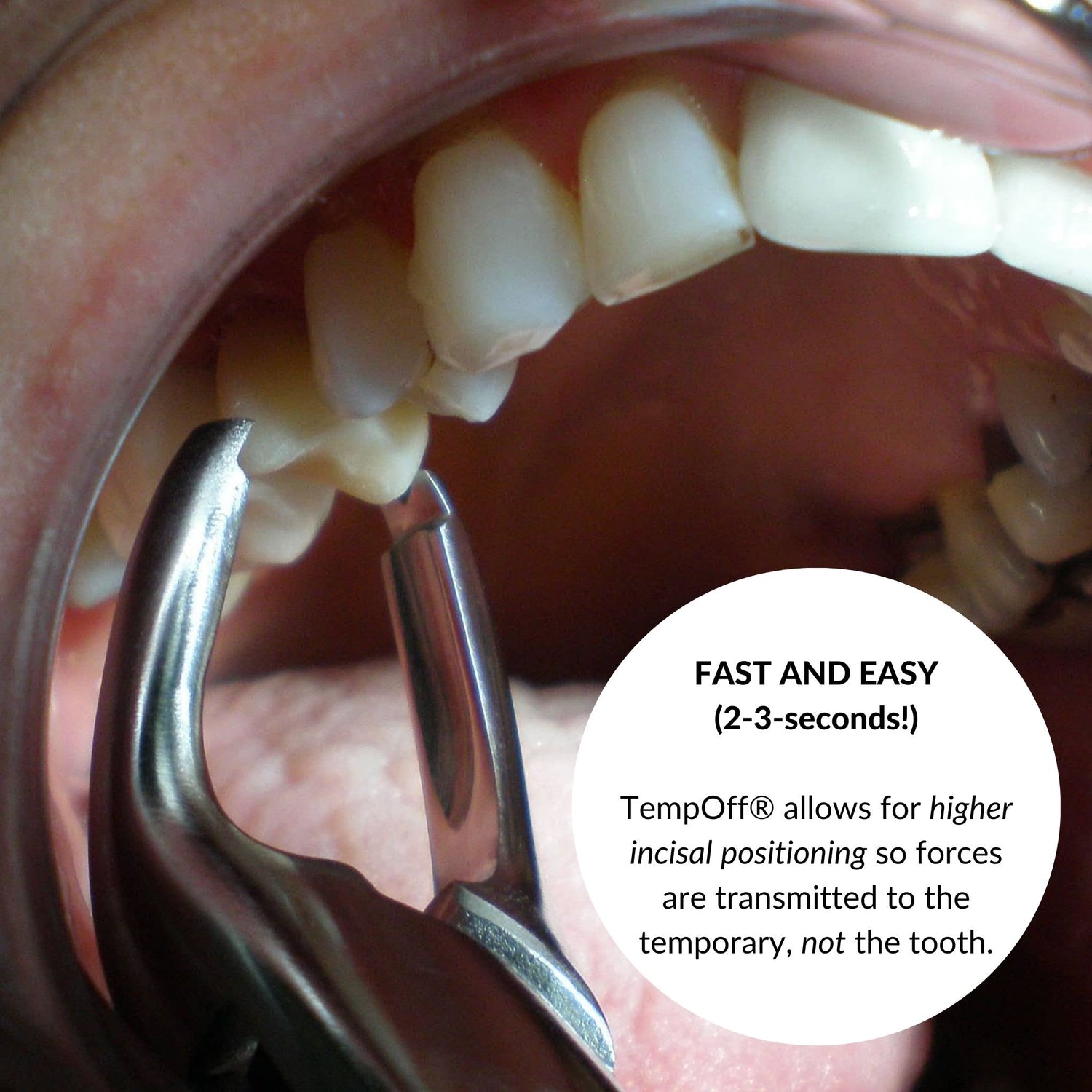 A New Temporary Crown Removal Method You Need to Try: How to Remove a